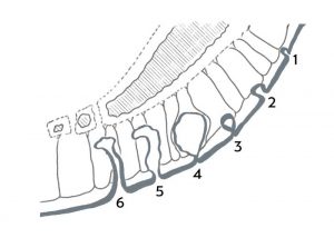 Steißbeinfistel erkennen und verstehen | Pilonidal Sinus Zentrum