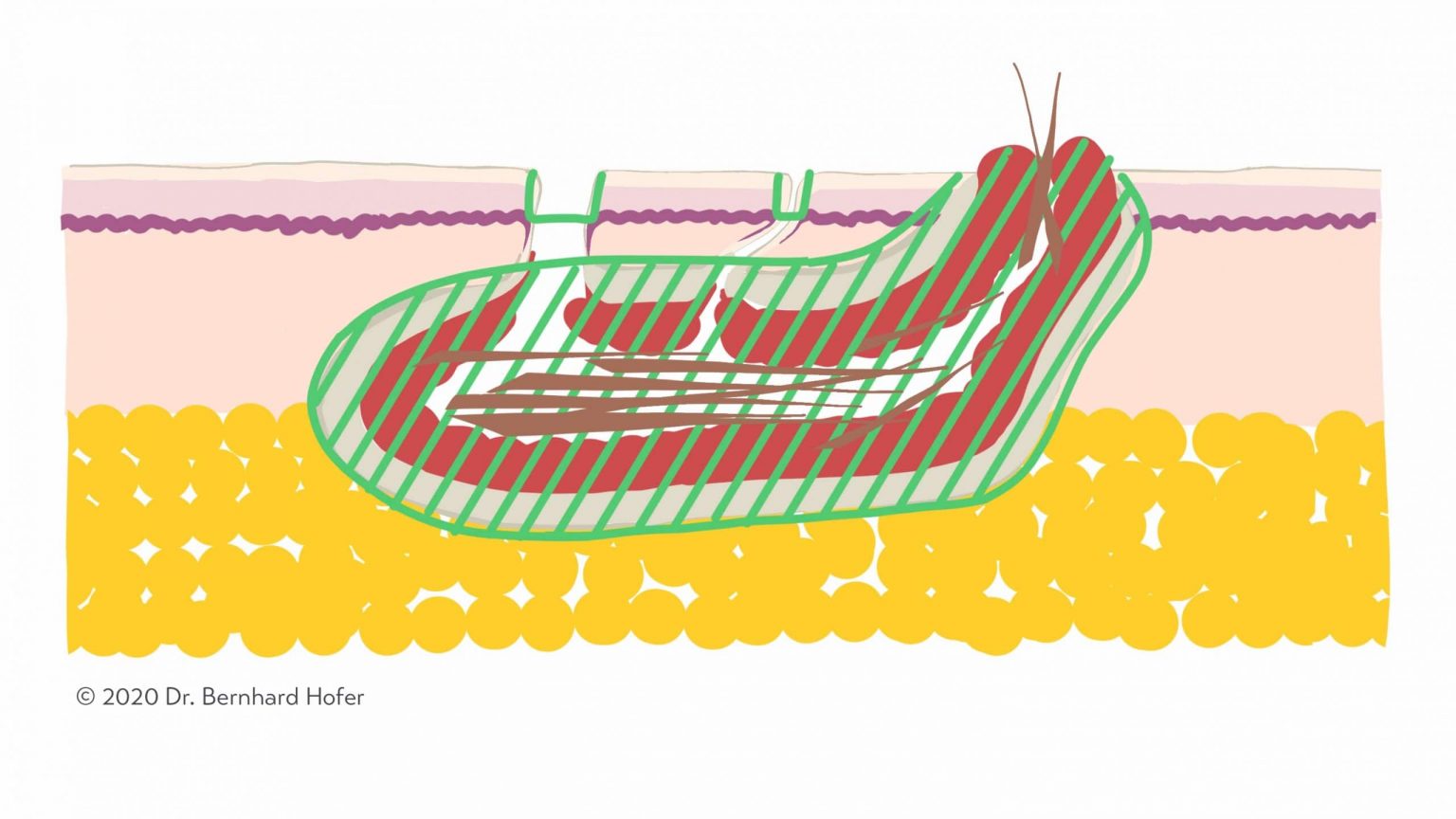 OP - Technik: Pit Picking - Pilonidal Sinus Zentrum